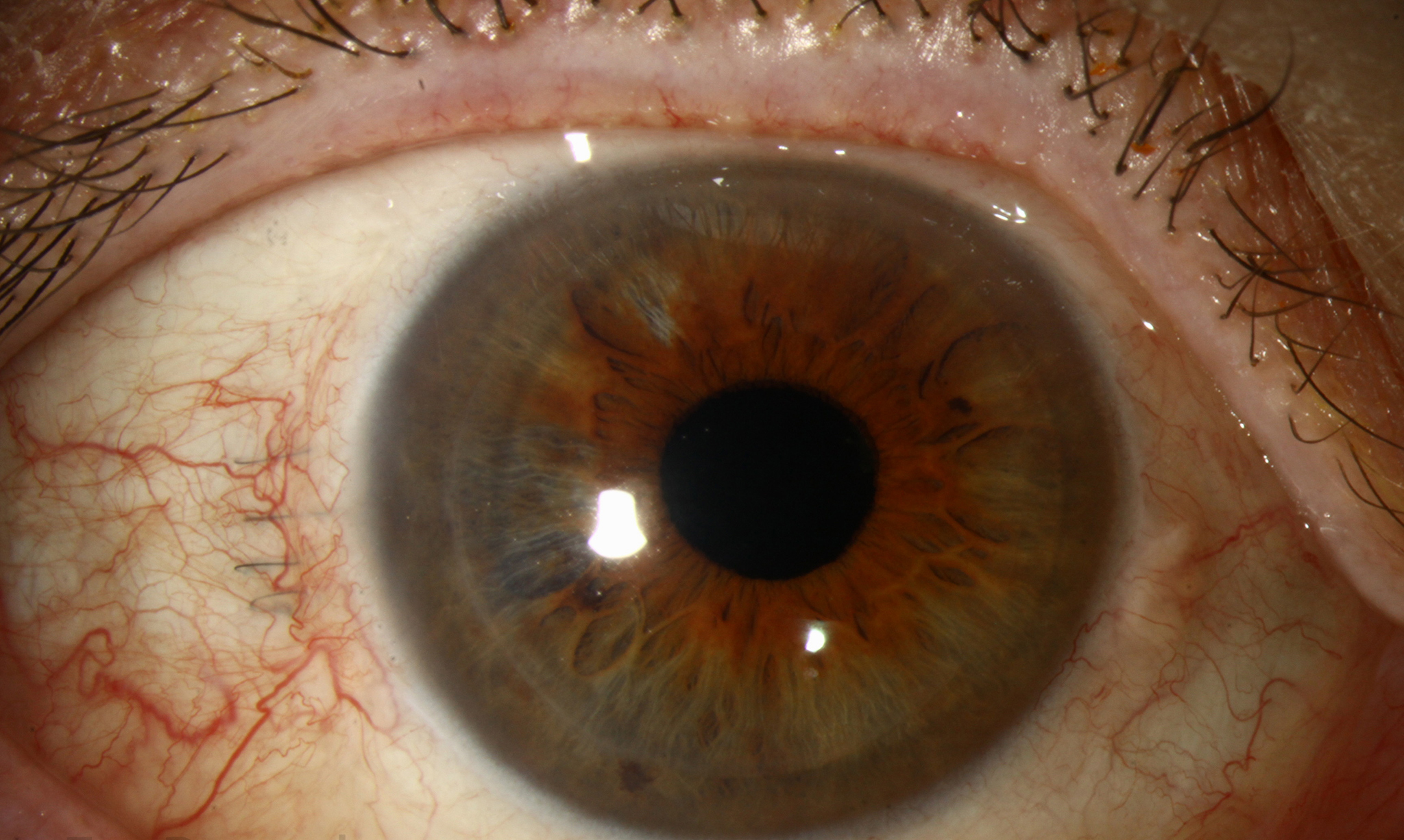 Cornea Burlington Cornea Transplant New England Vision