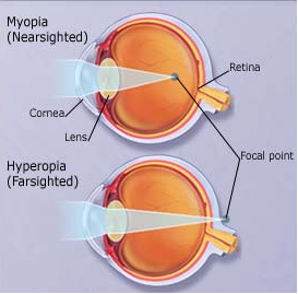 Farsighted Vs Nearsighted What S The Difference IPYGMC