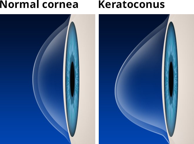 Conrea Burlington | Keratoconus Burlington | New England Vision